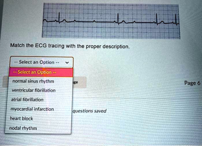 SOLVED: Match the ECG tracing with the proper description Select an ...