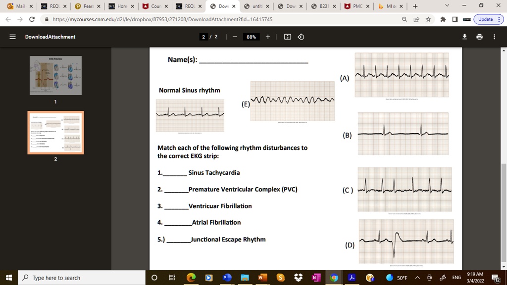 Name(s): Normal Sinus rhythm Match each of the following rhythm ...