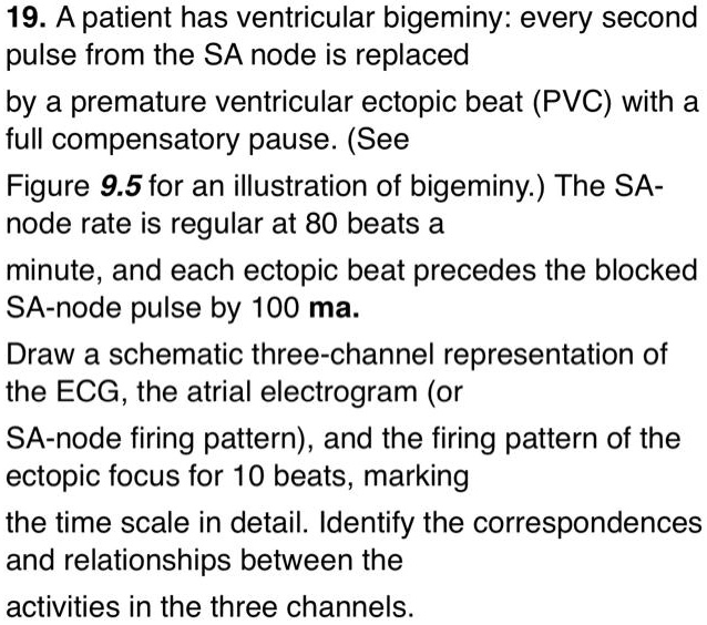 19. A patient has ventricular bigeminy: every second pulse from the SA ...