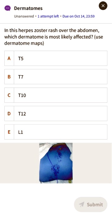 SOLVED: Dermatomes Unanswered Attempt left Due on Oct 14, 23:59 In this ...