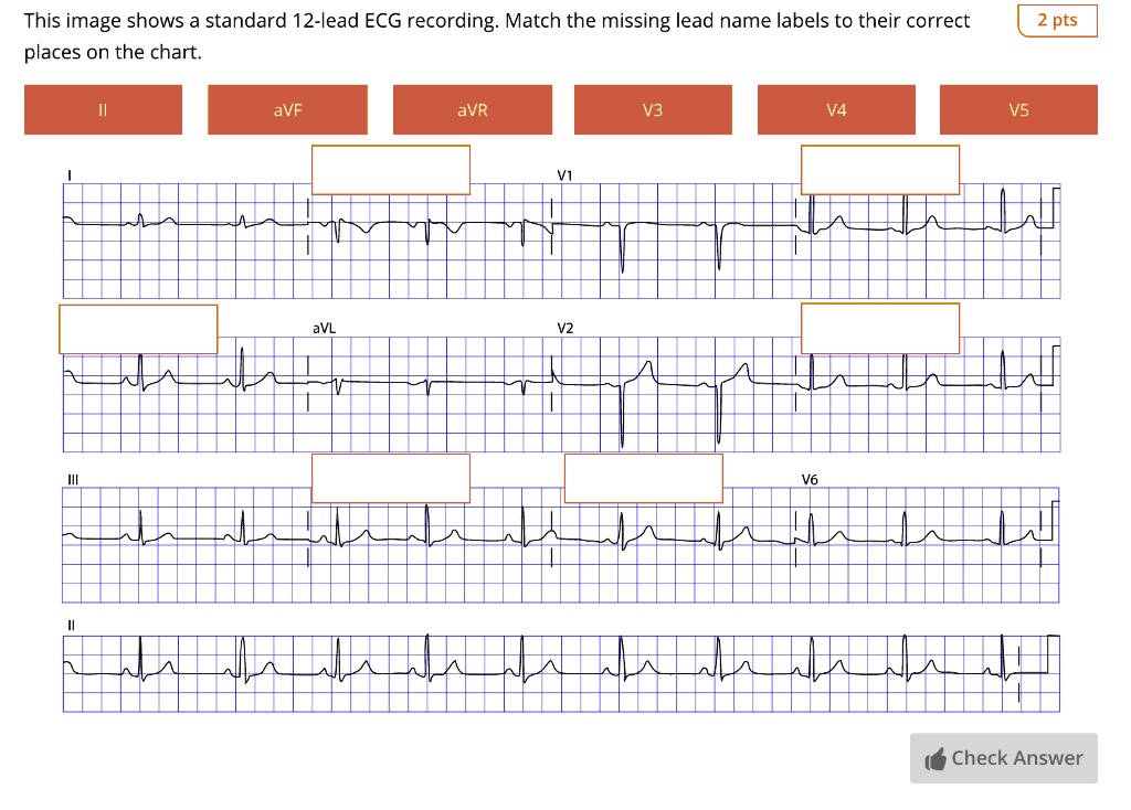 SOLVED: This image shows a standard 12-lead ECG recording. Match the ...