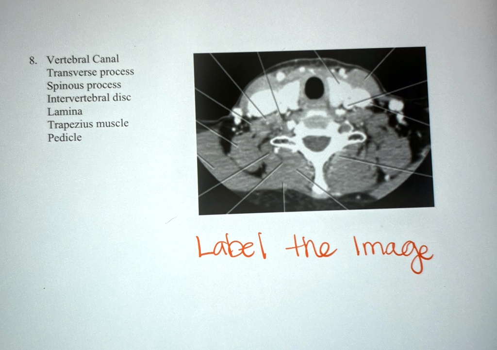 8. Vertebral Canal Transverse process Spinous process Intervertebral ...