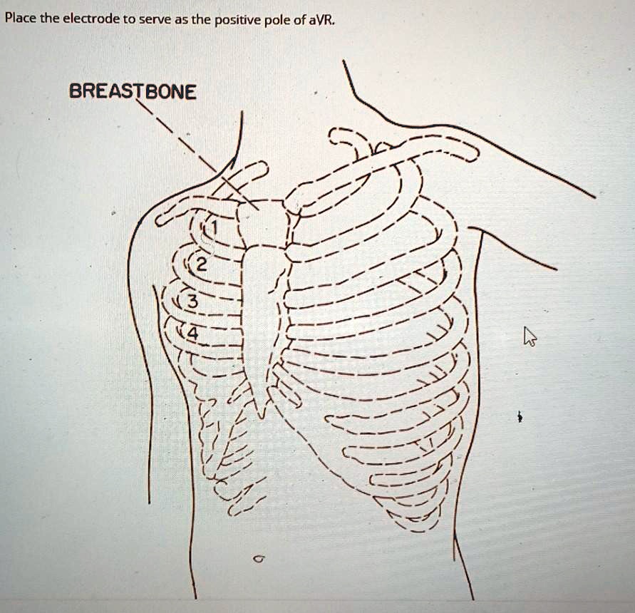 SOLVED: Place the electrode to serve as the positive pole . of aVR ...