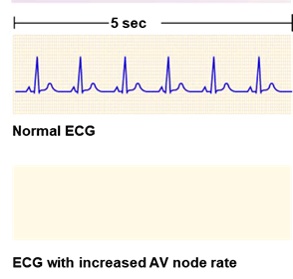 Normal ECG ECG with increased AV node rate