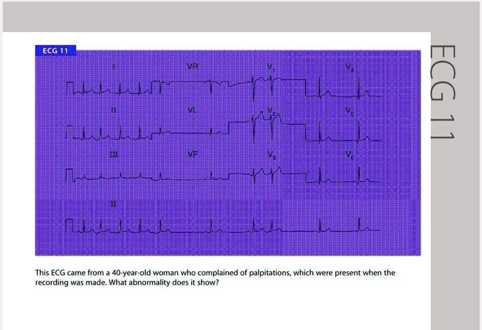SOLVED: ECG This ECG came from a 40-year-old woman who complained of ...