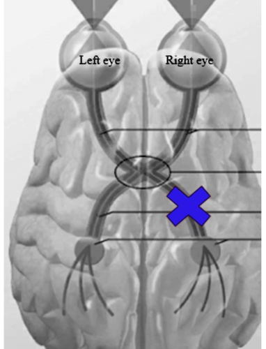 A patient had a CVA in the area indicated by the red x in the figure ...