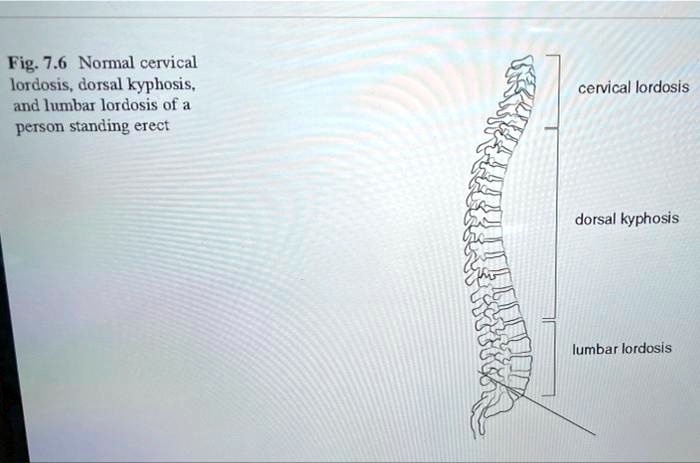 SOLVED: Fig: 7.6 Nommal cervical lordosis; dorsal kyphosis. and lumbar ...