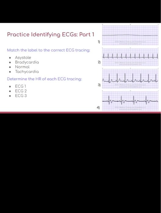 SOLVED: Practice Identifying ECGs Part 1 Match the label to the correct ...