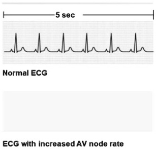 SOLVED: The AV node is made up of pacemaker cells similar to the SA ...
