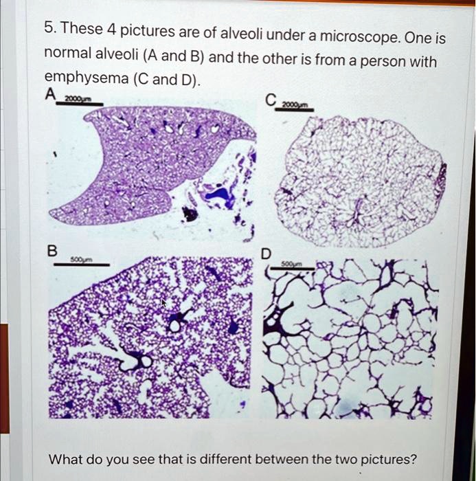 5. These 4 pictures are of alveoli under a microscope. One is normal ...