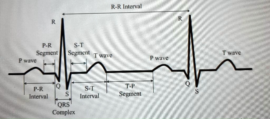 SOLVED: On the above ECG tracing, use brackets or shading to label the ...