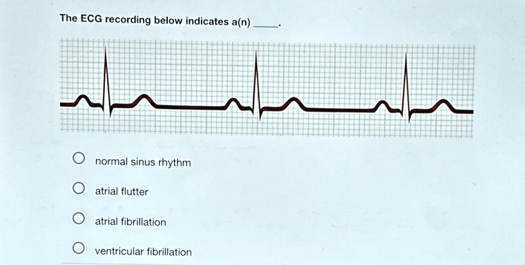 The ECG recording below indicates a(n) normal sinus rhythm atrial ...