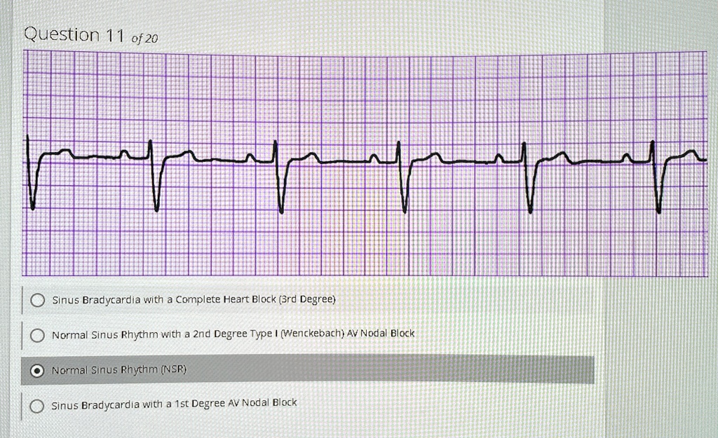 question 11 of 20 sinus bradycardia with a complete heart block 3rd ...