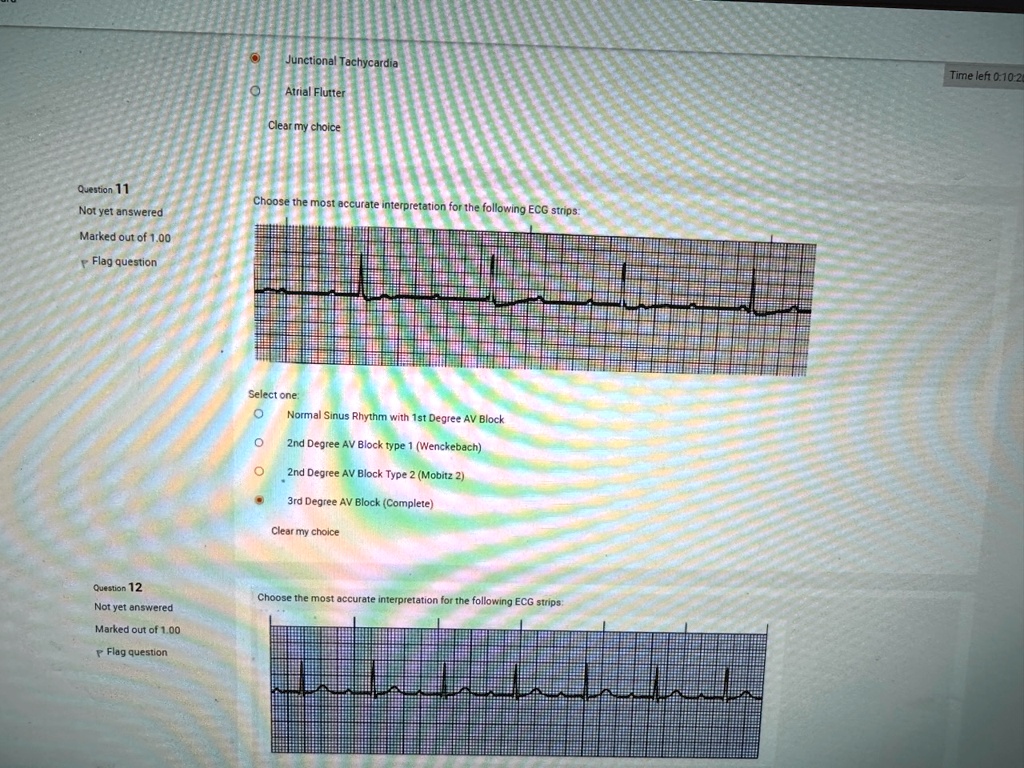 SOLVED: Flag question Select one: Normal Sinus Rhythm with Premature ...