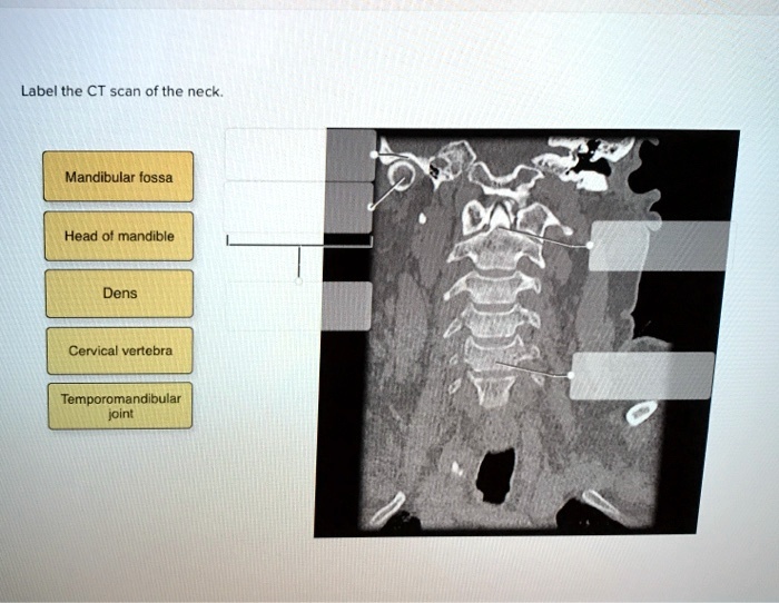 SOLVED: Label the CT scan of the neck Mandibular fossa Head of mandible ...