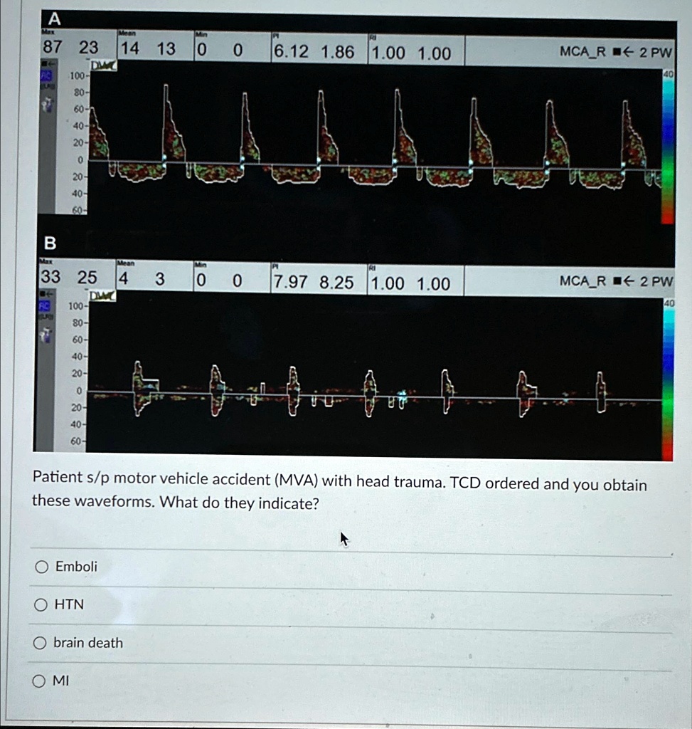 Patient (s/p) motor vehicle accident (MVA) with head trauma. TCD ...
