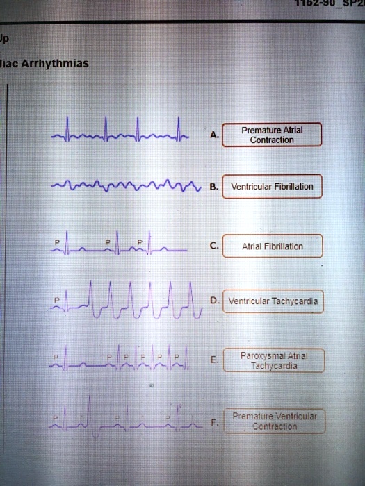 SOLVED: 1152-903F Cardiac Arrhythmias Premature Atrial Contraction ...