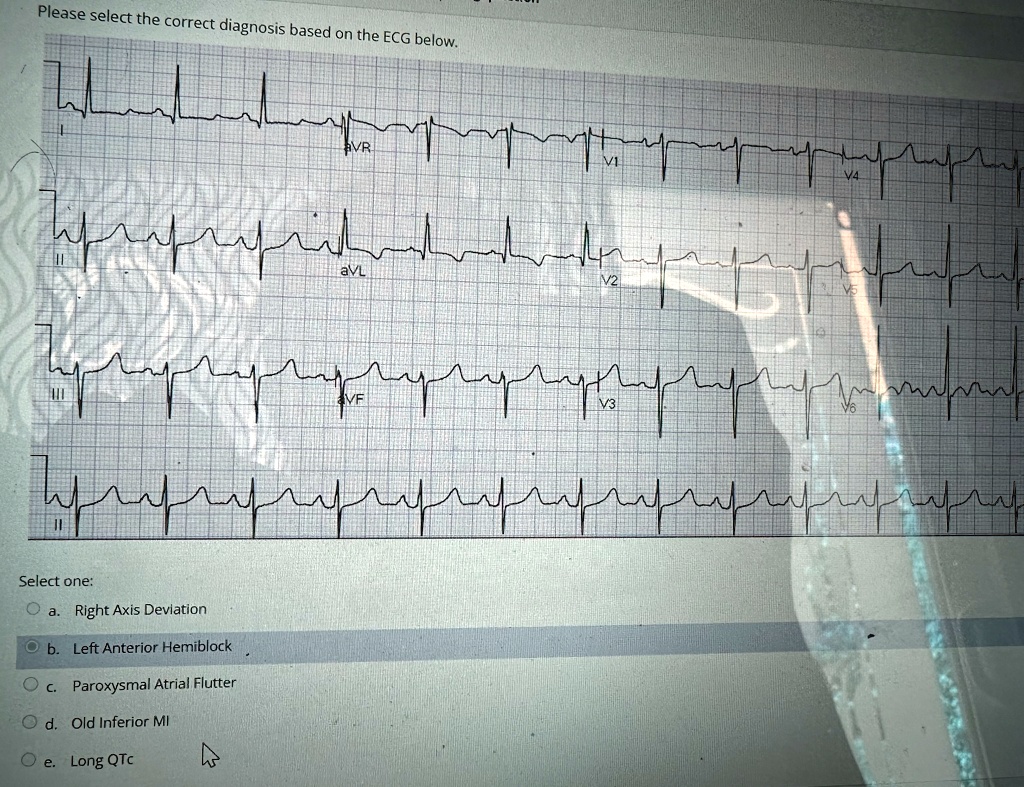 please select the correct diagnosis based on the ecg below select one a ...