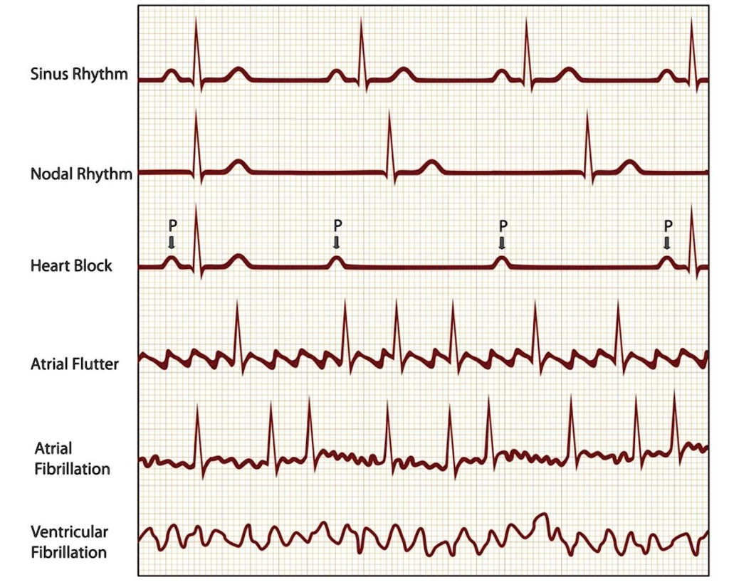 Sinus Rhythm Nodal Rhythm Heart Block Atrial Flutter Atrial ...