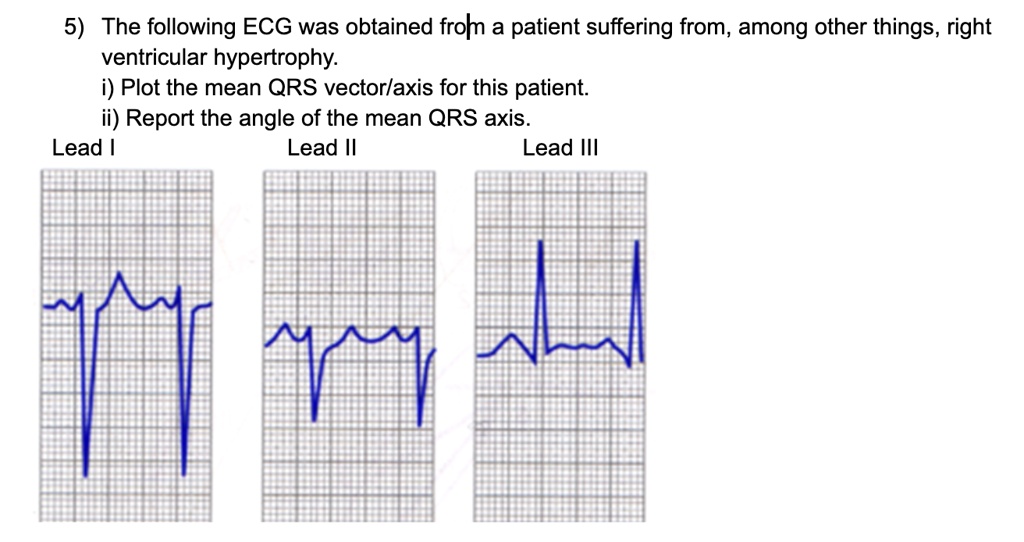5) The following ECG was obtained from a patient suffering from, among ...