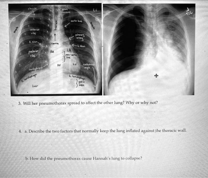 clavicle ribs trochea Carina RA LA R hilum liver RV LV 3. Will her ...