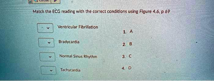 Match the ECG reading with the correct conditions Using Figure 4.6,p 69 ...