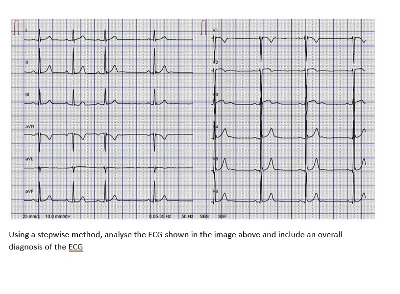 SOLVED: Texts: Using a stepwise method, analyze the ECG shown in the ...