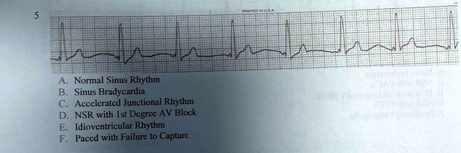 a normal sinus rhythm b sinus bradycardia c accelerated junctional ...