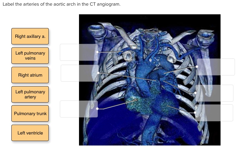 Label the arteries of the aortic arch in the CT angiogram. Right ...