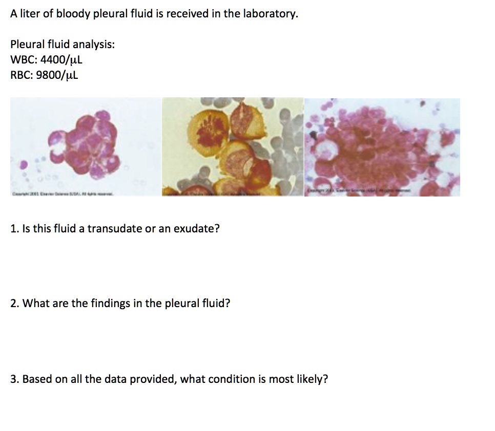 a liter of bloody pleural fluid is received in the laboratory pleural ...