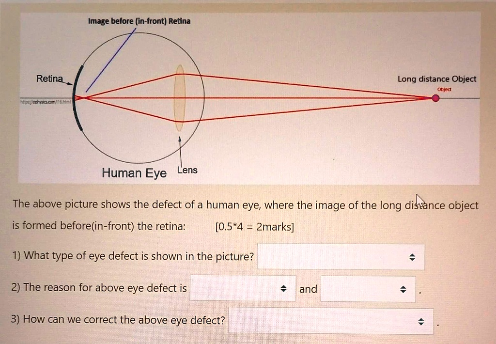 SOLVED:Image before (in-front) Retina Retina_ Long distance Object ...