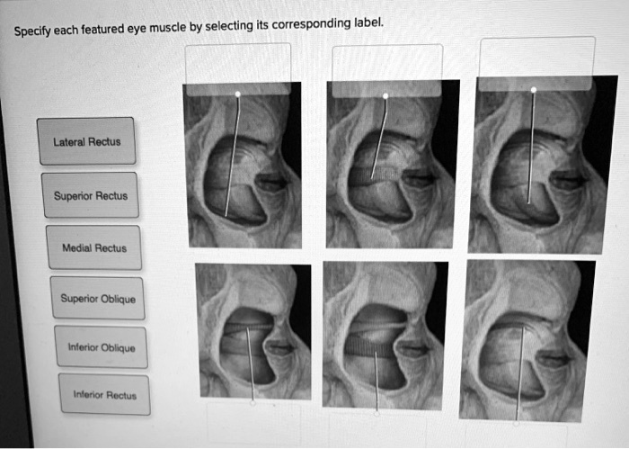 Specify each featured eye muscle by selecting its corresponding label ... Specify each featured eye muscle by selecting its corresponding label ...