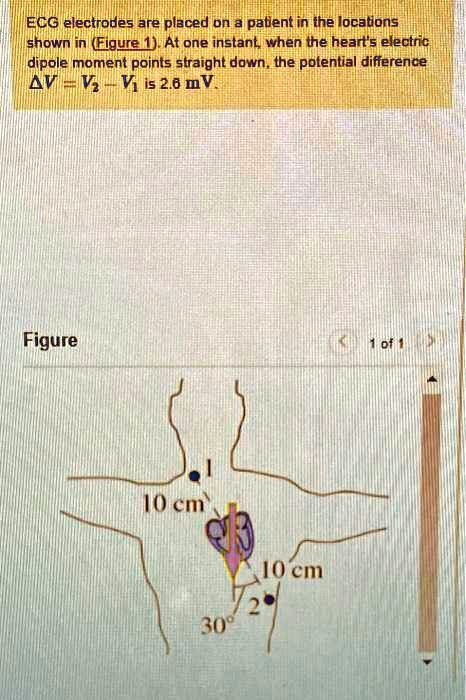 ECG electrodes are placed on a patient in the locations shown in Figure ...
