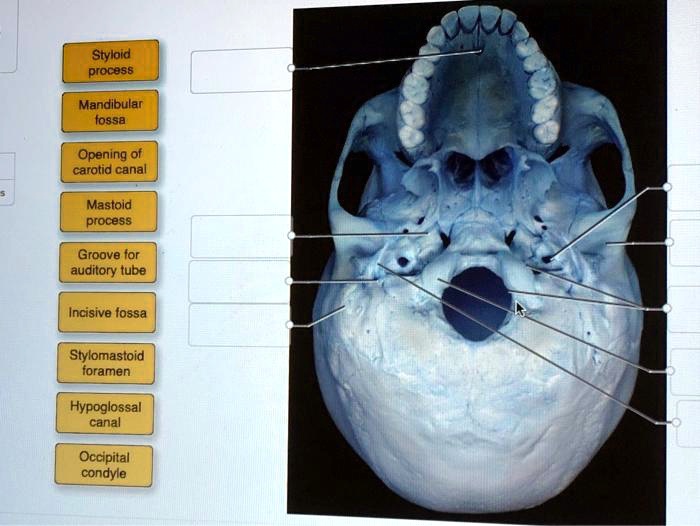 SOLVED: Styloid process Mandibular fossa Opening of carotid canal ...