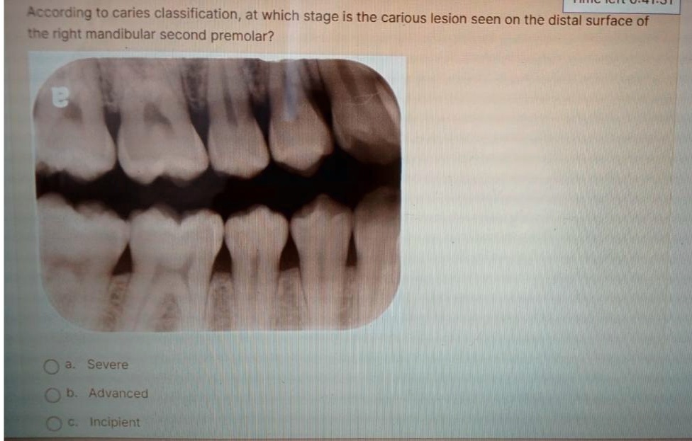 SOLVED: According to caries classification, at which stage is the ...