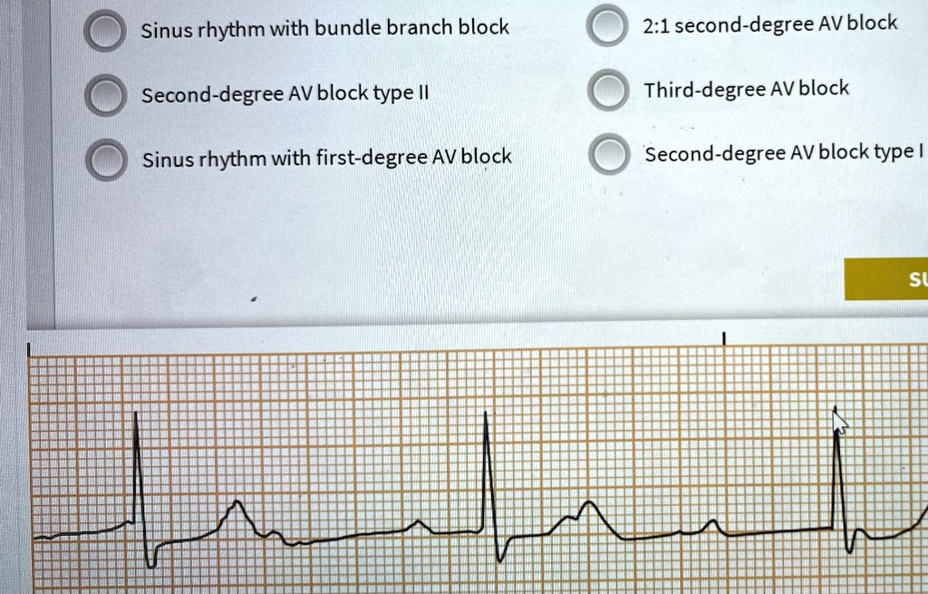 SOLVED: Texts: 1. Sinus rhythm with bundle branch block 2. 2:1 second ... SOLVED: Texts: 1. Sinus rhythm with bundle branch block 2. 2:1 second ...