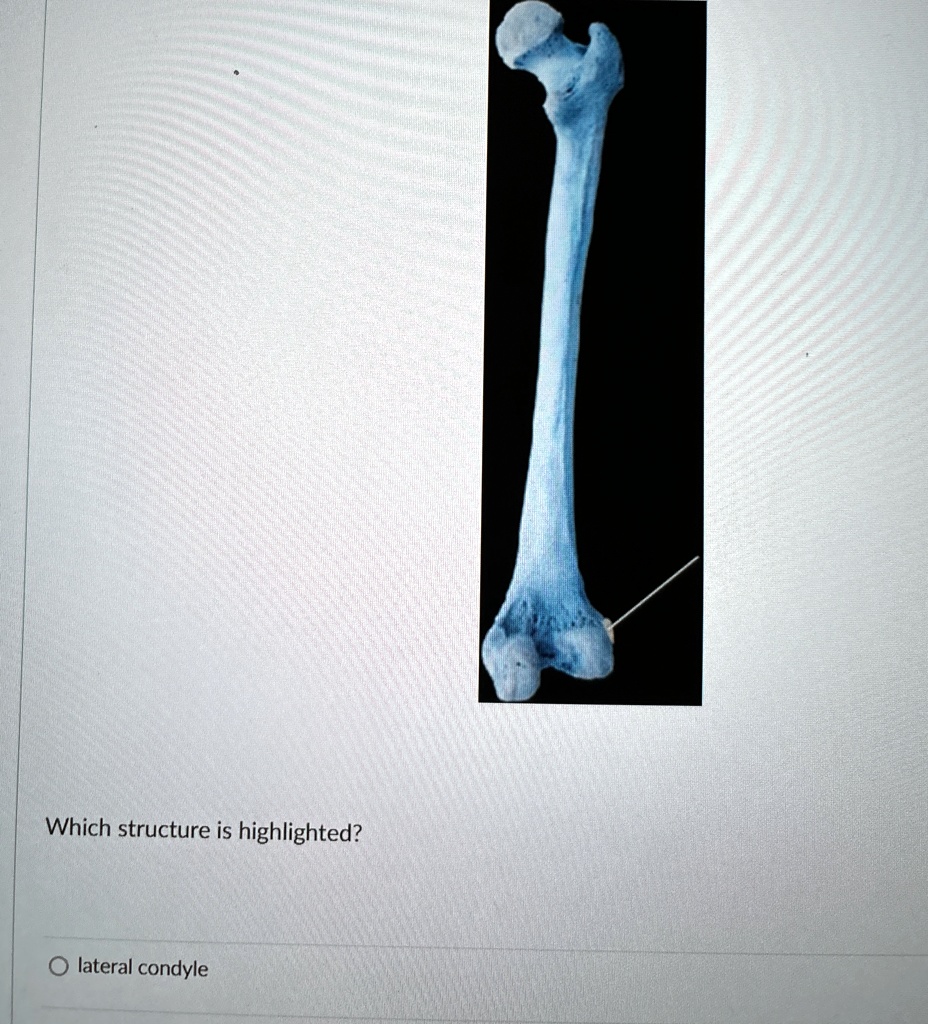 Which structure is highlighted? lateral condyle