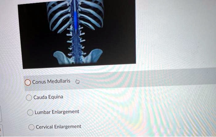 SOLVED: Conus Medullaris Cauda Equina Lumbar Enlargement Cervical ...