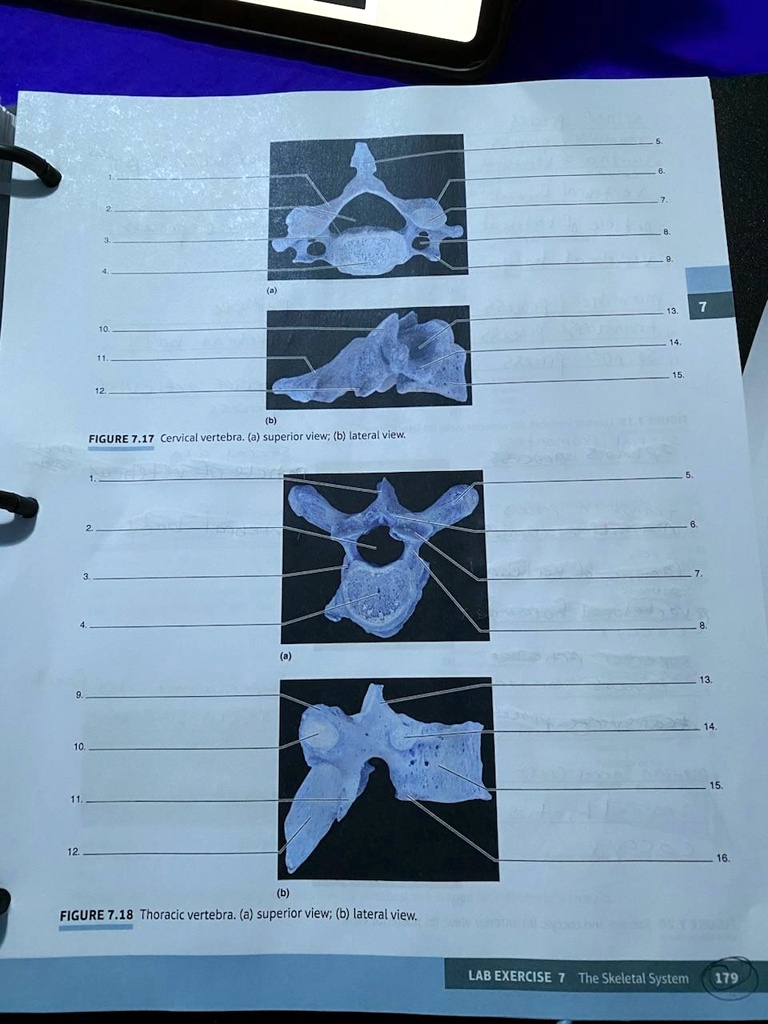 SOLVED: FIGURE 7.17 Cervical vertebrae - superior view, lateral view (a ... SOLVED: FIGURE 7.17 Cervical vertebrae - superior view, lateral view (a ...