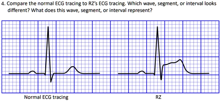 4. Compare the normal ECG tracing to RZ's ECG tracing. Which wave ...