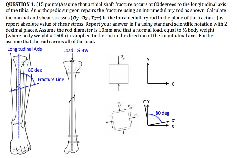 SOLVED: QUESTION 1: (15 points) Assume that a tibial shaft fracture ...