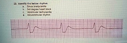 22 identify the below rhythm a sinus bradycardia b 3rd degree heart ...