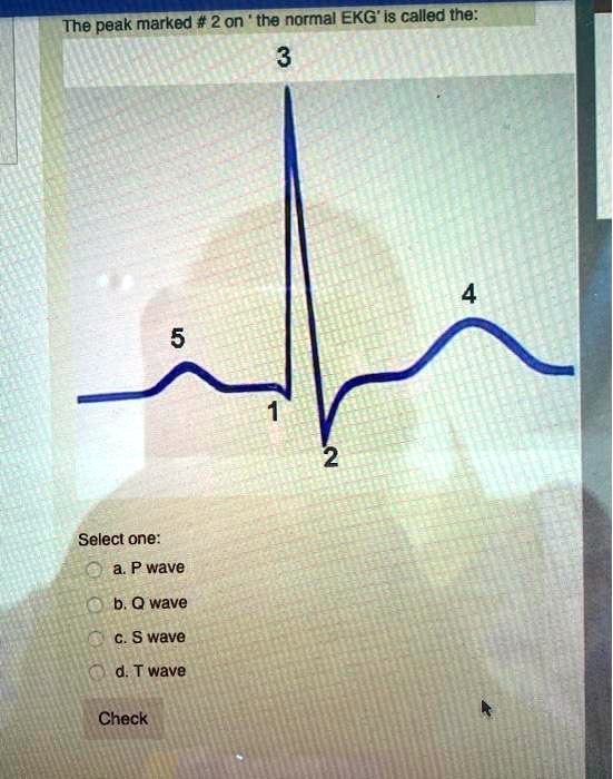 SOLVED: The peak marked #2 on the normal EKG is called the: Select one ...