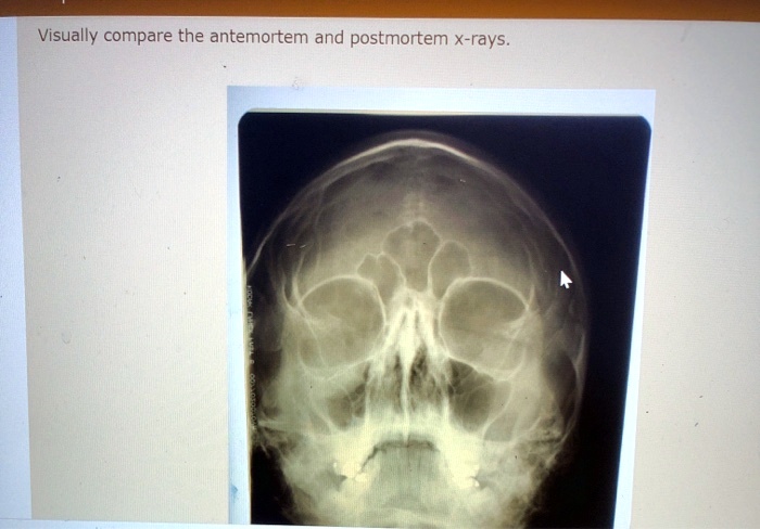 SOLVED: Visually compare the antemortem and postmortem X-rays.