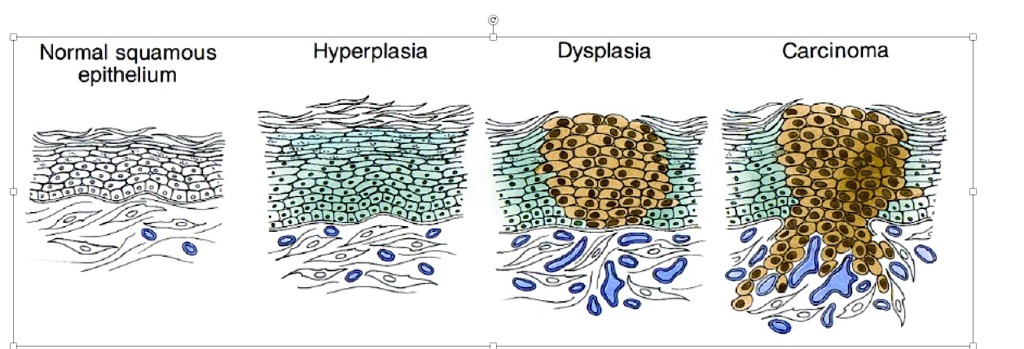 SOLVED: Normal squamous epithelium Hyperplasia Dysplasia Carcinoma