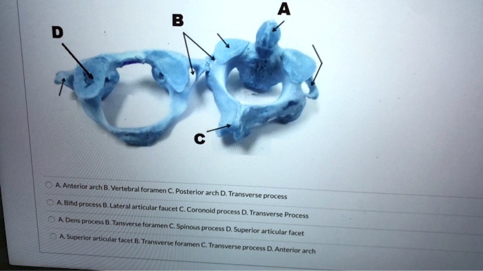 anterior arch vertebral foramen posterior arch transverse prorlss bifid ...
