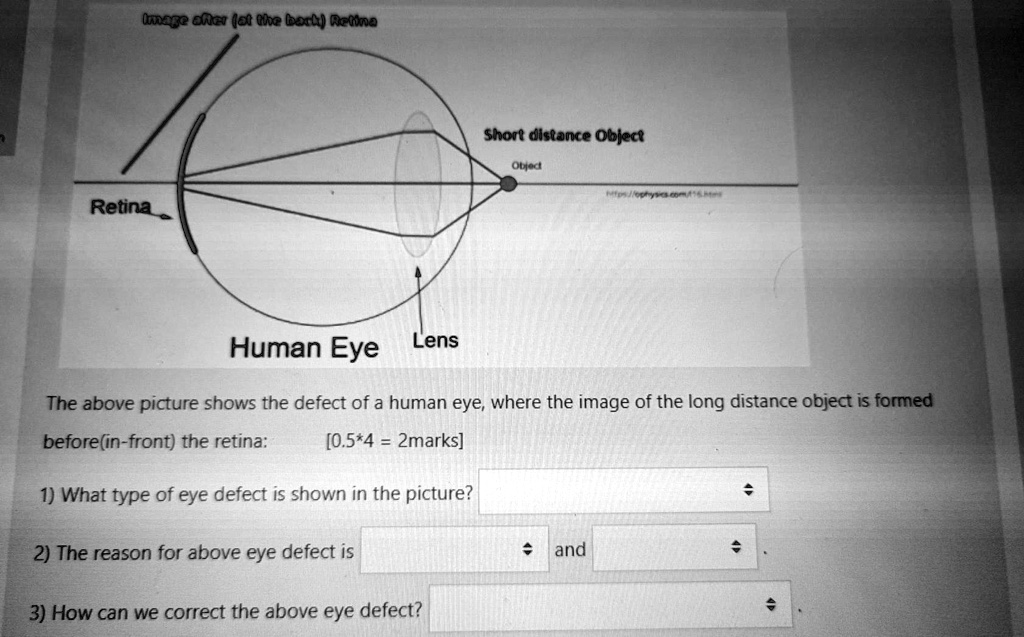 nage anet ett ohe balv aalina short distance obkect oljed retina human ...