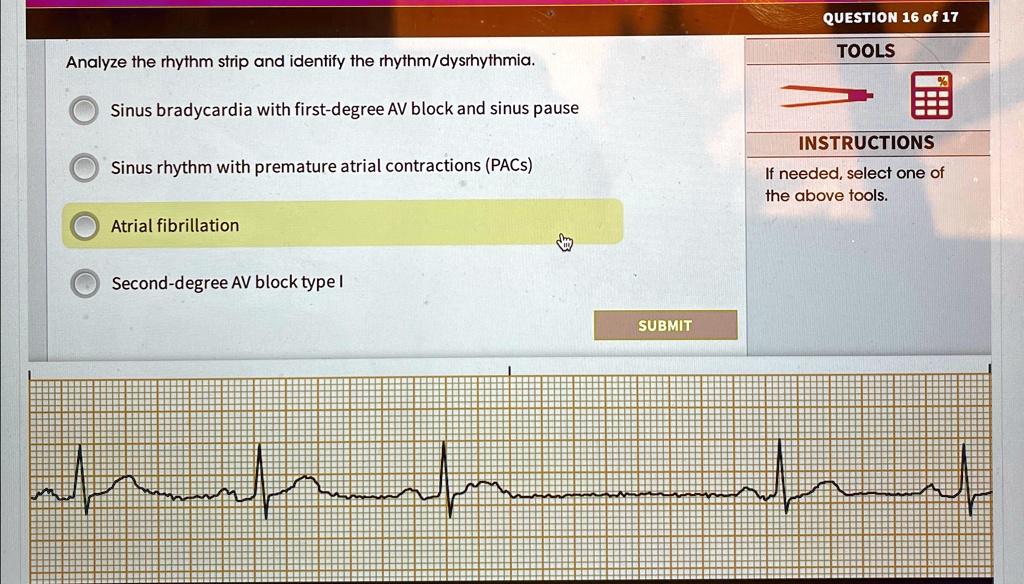 Analyze the rhythm strip and identify the rhythm/dysrhythmia. Sinus ...