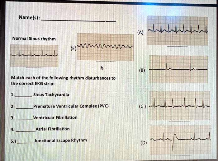 Normal Sinus rhythm Match each of the following rhythm disturbances to ...