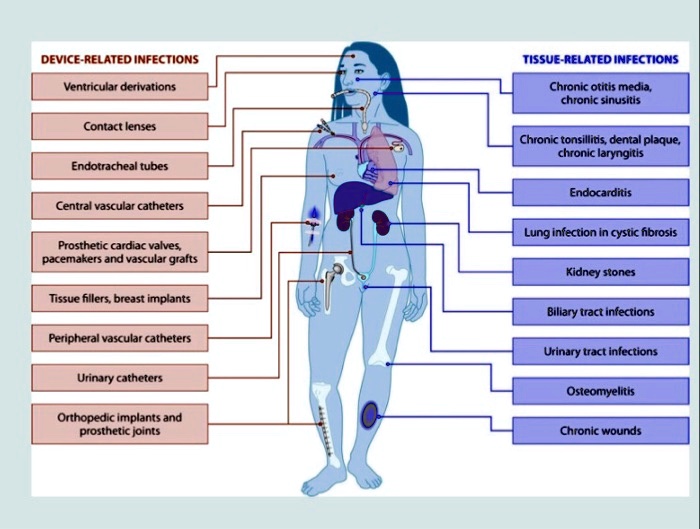 DEVICE-RELATED INFECTIONS Ventricular derivations Contact lenses ...